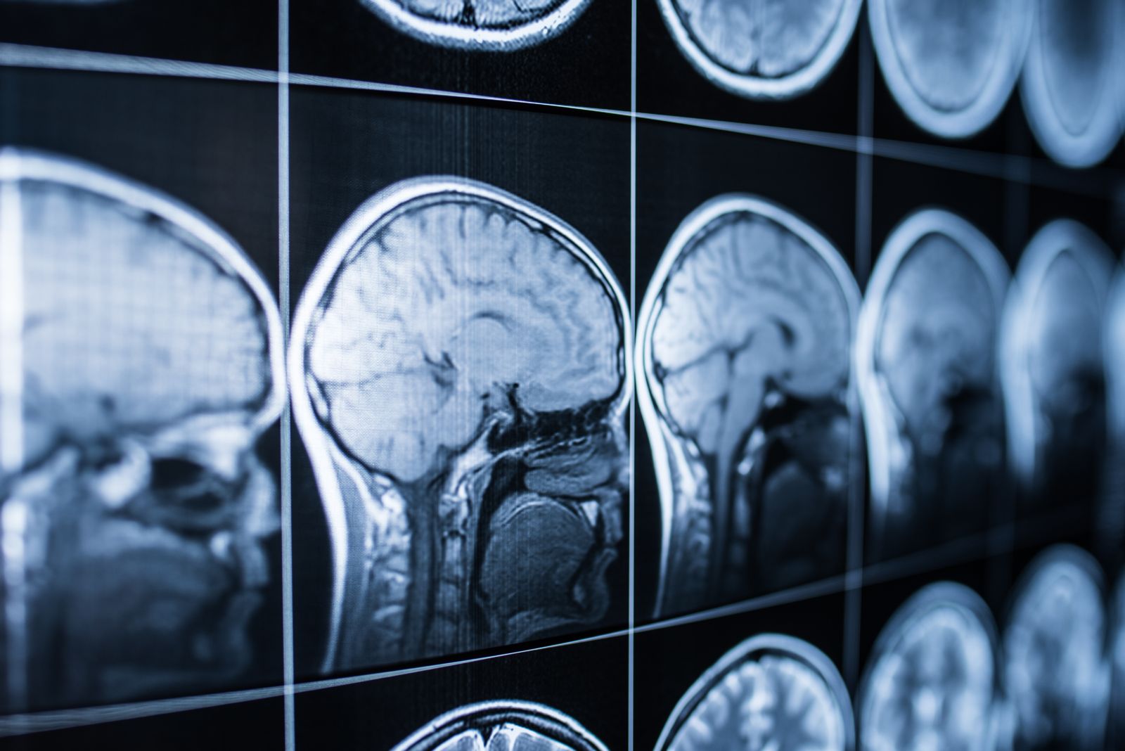 Head Injuries Causing Brain Damage | Samples Ames, PLLC